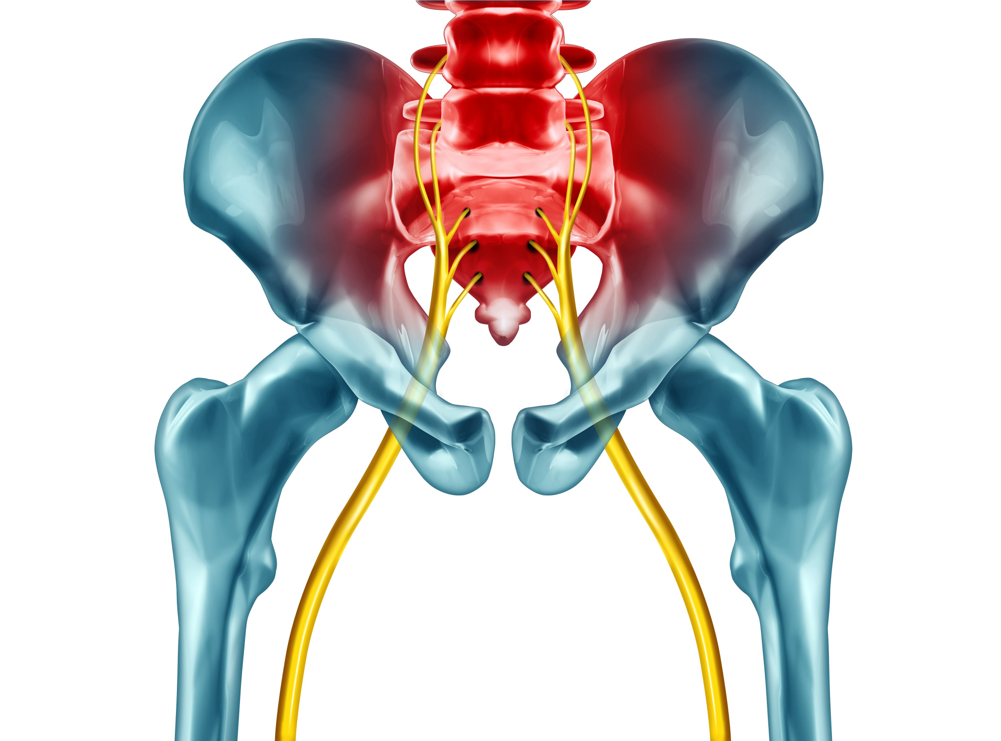Sciatica - LexiMed